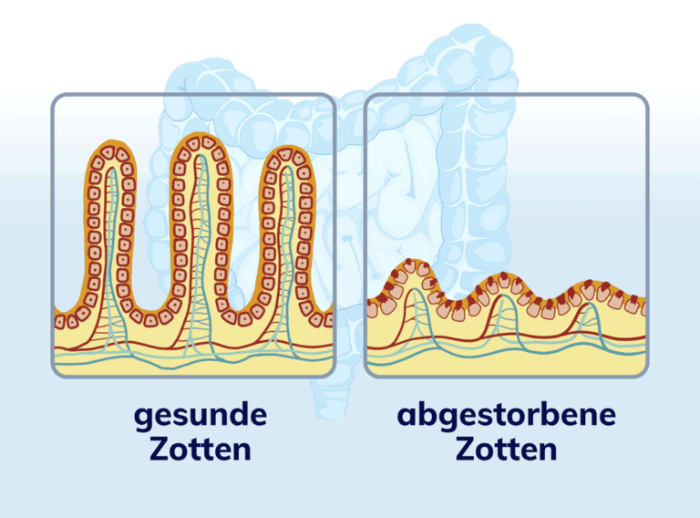 Zöliakie (Gluten-Unverträglichkeit) erkennen & behandeln